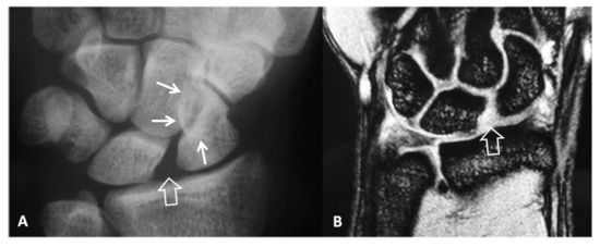 SLAC and SNAC Wrist: The Top Five Things That General Radiologists Need ...