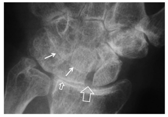 SLAC and SNAC Wrist: The Top Five Things That General Radiologists Need ...