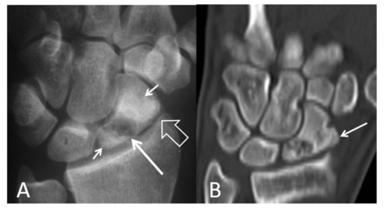 SLAC and SNAC Wrist: The Top Five Things That General Radiologists Need ...
