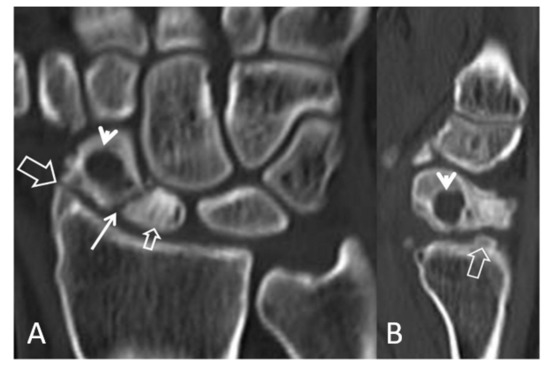 SLAC and SNAC Wrist: The Top Five Things That General Radiologists Need ...