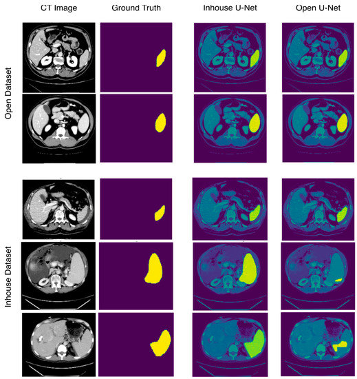 Evaluation of a Deep Learning Algorithm for Automated Spleen Segmentation in Patients with ...