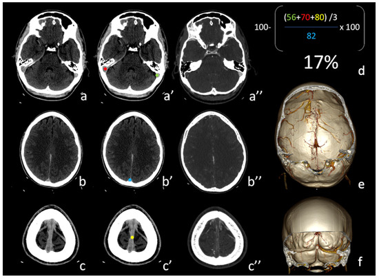 Cerebral Venous Thrombosis: A Challenging Diagnosis; A New Nonenhanced ...