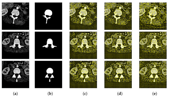 Fast Segmentation of Vertebrae CT Image Based on the SNIC Algorithm