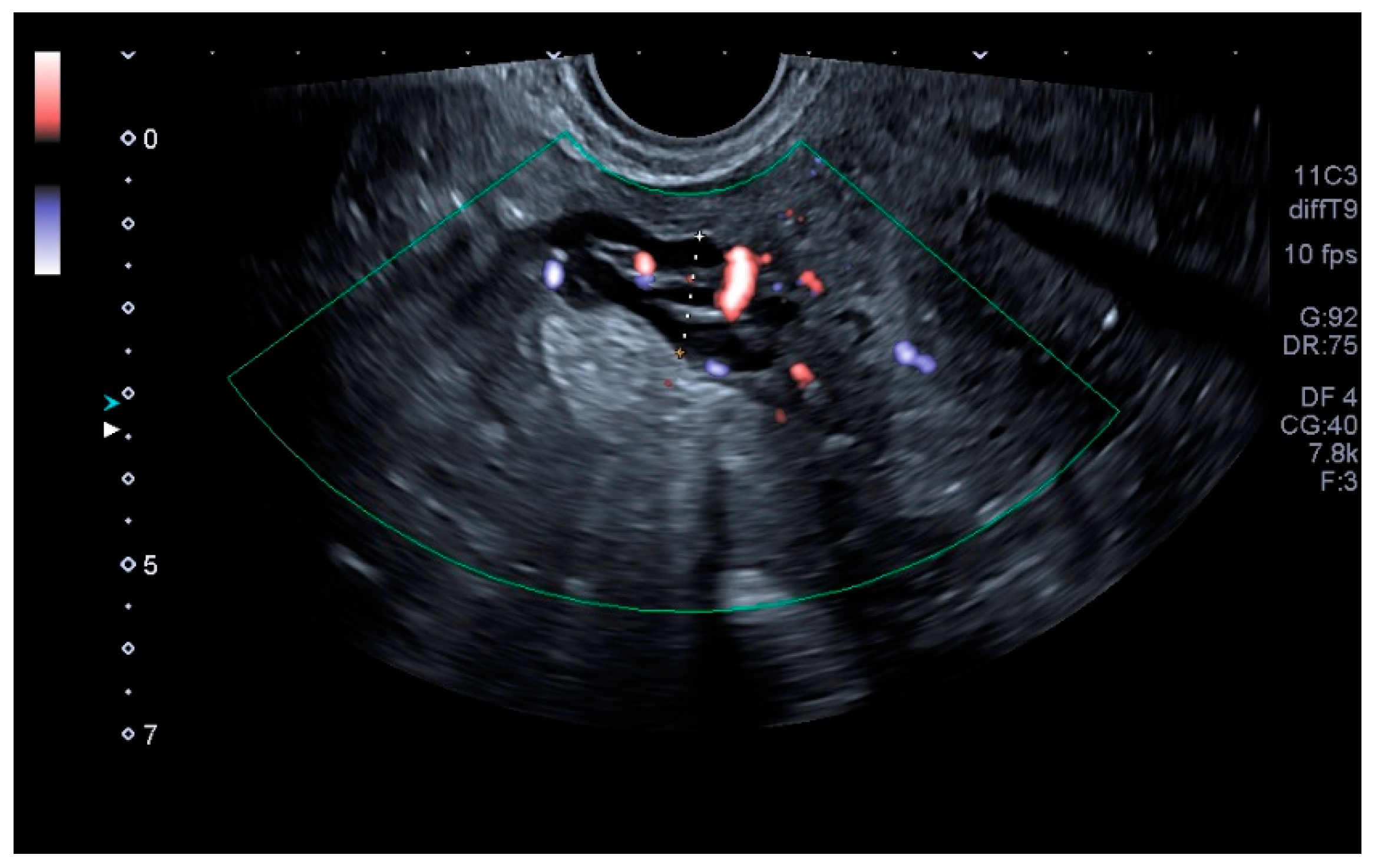 Tomography Free Full Text Identification Of Pelvic Congestion