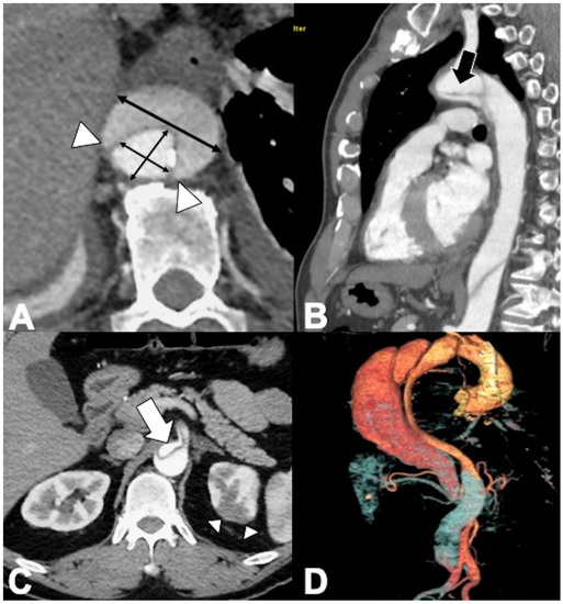 MDCT Imaging of Non-Traumatic Thoracic Aortic Emergencies and Its ...