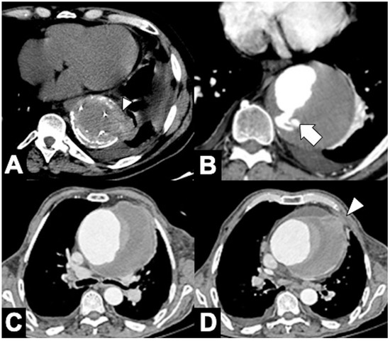 MDCT Imaging of Non-Traumatic Thoracic Aortic Emergencies and Its ...