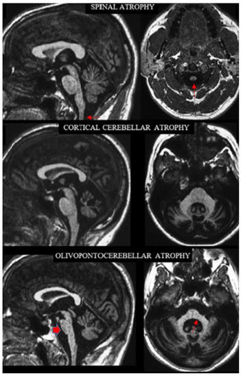 MRI CNS Atrophy Pattern and the Etiologies of Progressive Ataxias