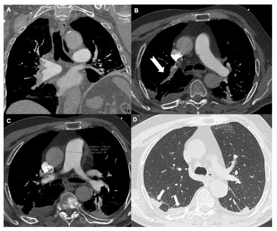 Tomography Free Full Text Acute Pulmonary Embolism Prognostic Role