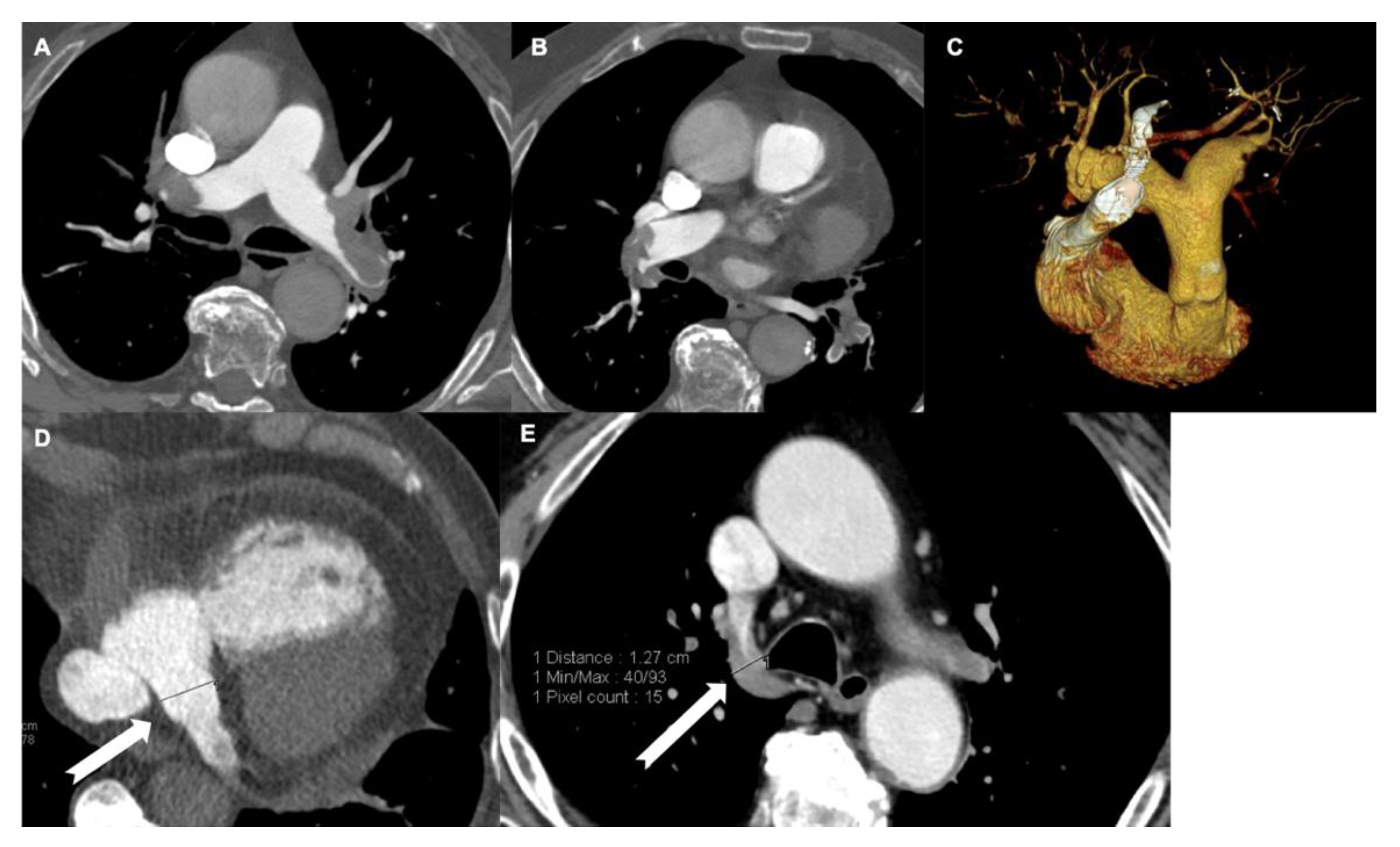 Tomography Free Full Text Acute Pulmonary Embolism Prognostic Role