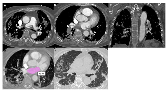 Acute Pulmonary Embolism: Prognostic Role of Computed Tomography ...