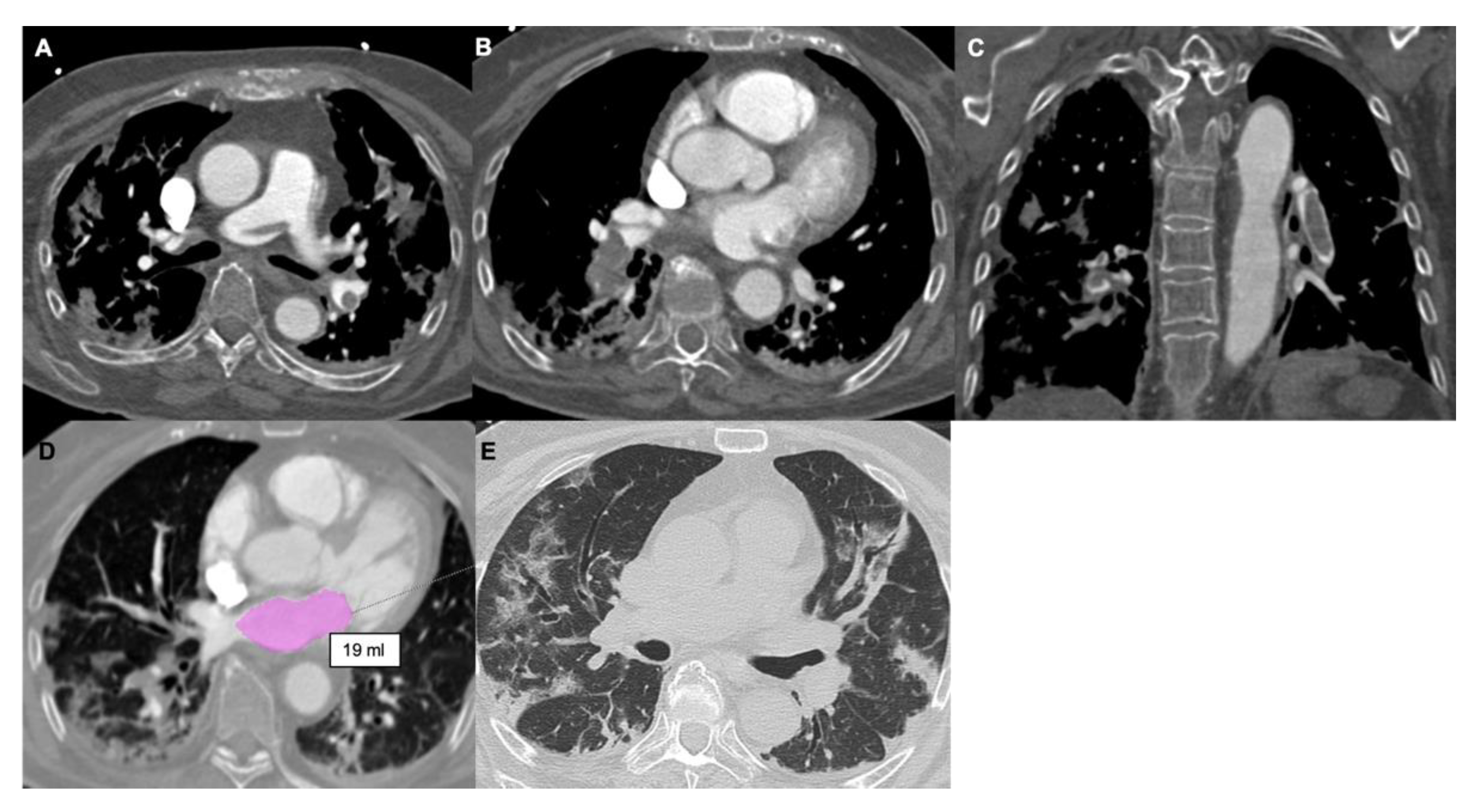 Tomography Free Full Text Acute Pulmonary Embolism Prognostic Role