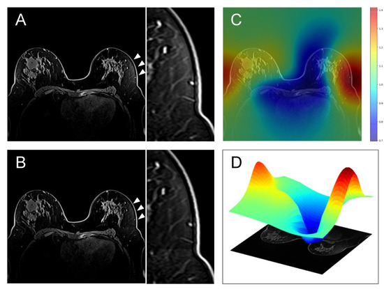 Post-Processing Bias Field Inhomogeneity Correction for Assessing ...