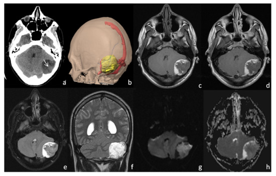 Dermoid Cysts of the Asterion: An Unusual Location for Unusual Dermoids ...