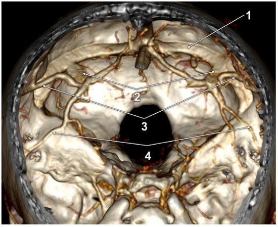A New Classification of the Anatomical Variations of Labbé’s Inferior ...