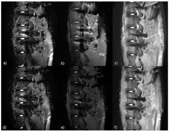 Tomography | Free Full-Text | Evaluating Compressed SENSE (CS) MRI ...