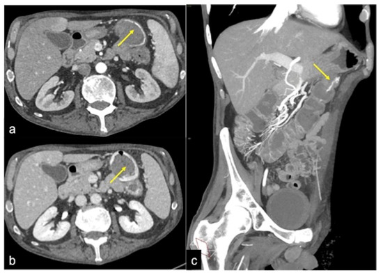 The Role of CT-Angiography in the Acute Gastrointestinal Bleeding: A ...