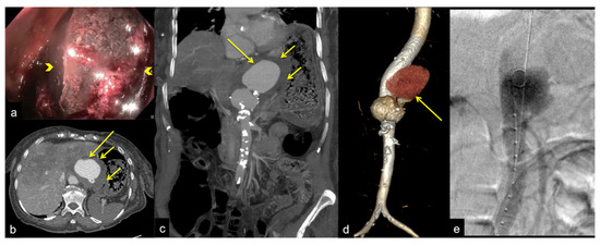 The Role of CT-Angiography in the Acute Gastrointestinal Bleeding: A ...