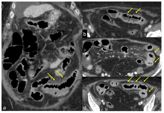 The Role of CT-Angiography in the Acute Gastrointestinal Bleeding: A ...