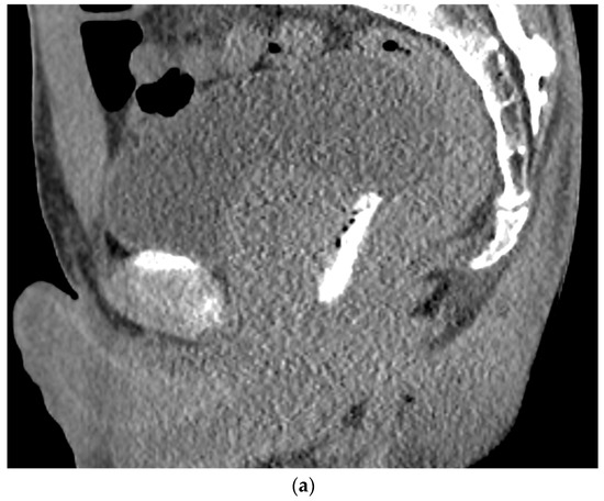 Application of Hydrogel Spacer SpaceOAR Vue for Prostate Radiotherapy