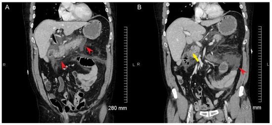 Intense FDG Uptake in the Common Bile Duct Post-ERCP Mimics Acute ...