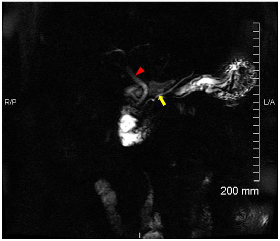 Intense FDG Uptake in the Common Bile Duct Post-ERCP Mimics Acute ...