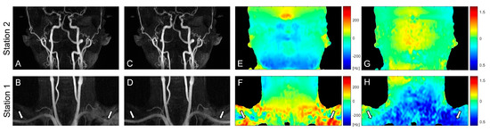Whole-Neck Non-Contrast-Enhanced MR Angiography Using Velocity ...