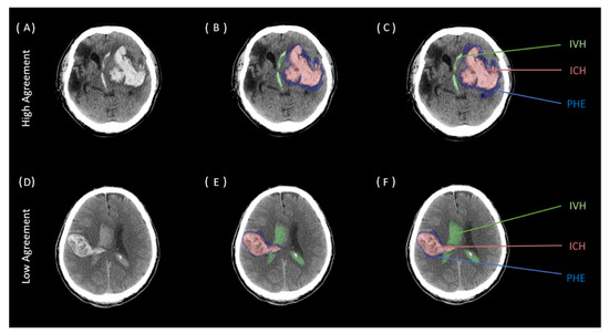 Multilesion Segmentations in Patients with Intracerebral Hemorrhage ...
