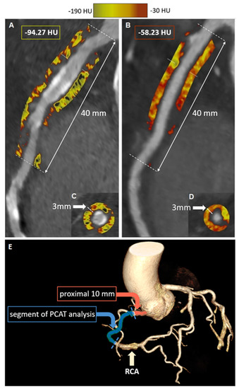 Advances in the Assessment of Coronary Artery Disease Activity with PET ...