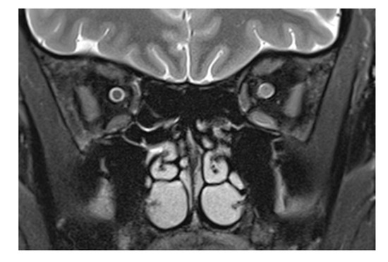 Tomography | Free Full-Text | Trauma to the Eye: Diffusion Restriction ...
