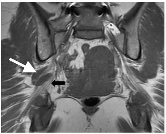Variant Sciatic Nerve Anatomy in Relation to the Piriformis Muscle on ...