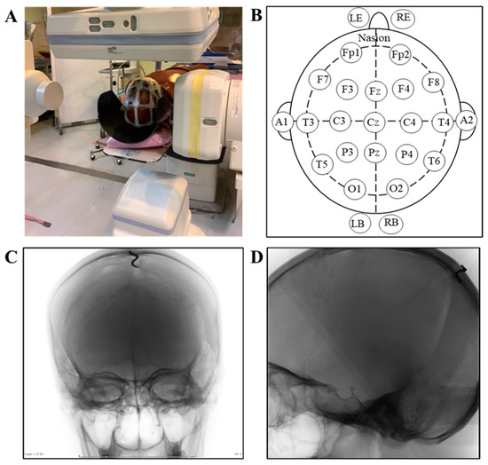 Comparing Radiation Dose of Cerebral Angiography Using Conventional and ...