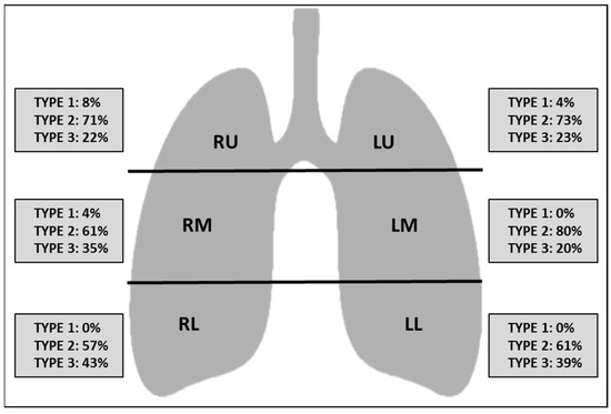 Tomography | Free Full-Text | Extension of Lung Damage at Chest ...