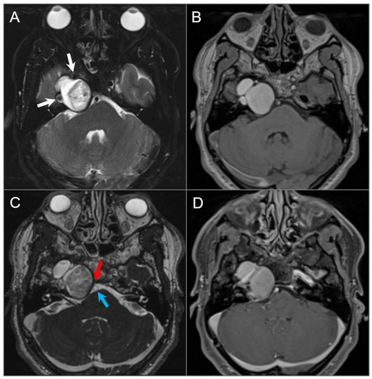 Imaging of Skull Base Tumors