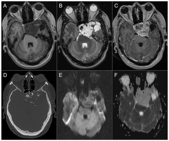 Imaging of Skull Base Tumors