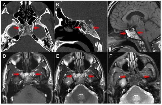 Imaging of Skull Base Tumors