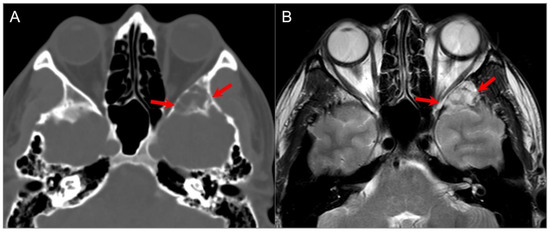Imaging of Skull Base Tumors