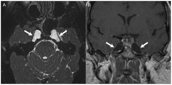 Imaging of Skull Base Tumors