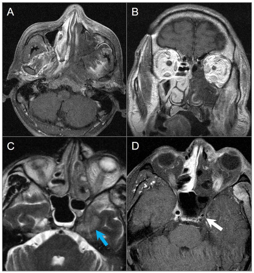 Imaging of Skull Base Tumors