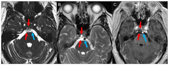 Imaging of Skull Base Tumors