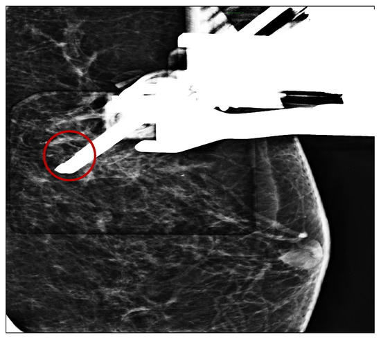 Vascular Complications following Vacuum-Assisted Breast Biopsy (VABB ...