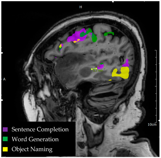 Tomography | Free Full-Text | Beyond Broca’s and Wernicke’s: Functional Mapping of Ancillary ...