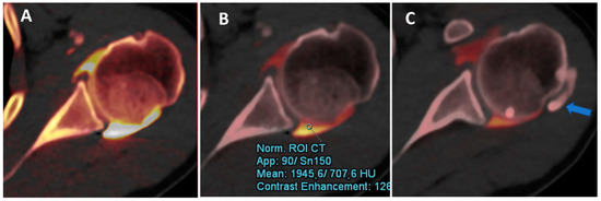 Tomography | Free Full-Text | Dual-Energy CT Arthrography: Advanced ...