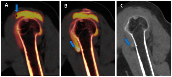 Tomography | Free Full-Text | Dual-Energy CT Arthrography: Advanced ...