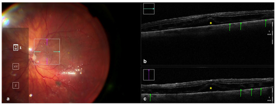 The State of Intraoperative OCT in Vitreoretinal Surgery: Recent ...