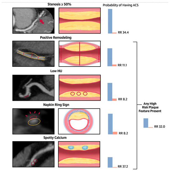 Non-Calcified Coronary Artery Plaque on Coronary Computed Tomography ...