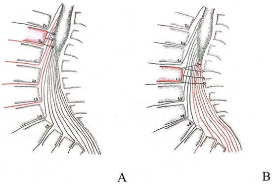 High-Riding Conus Medullaris Syndrome: A Case Report and Literature ...