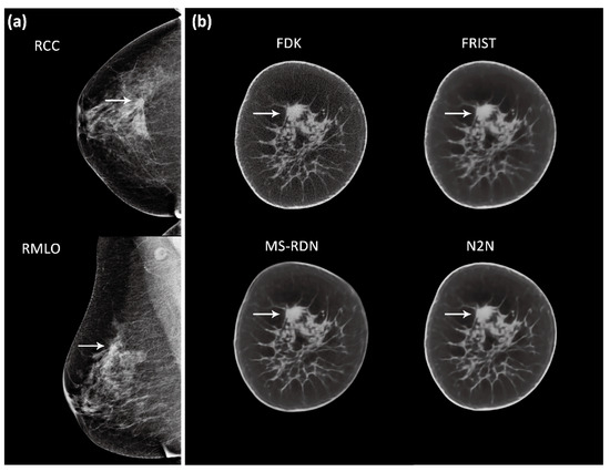 Dedicated Cone-Beam Breast CT: Reproducibility of Volumetric Glandular ...