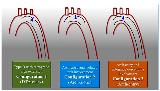 Non-A Non-B Acute Aortic Dissection: Is There Some Confusion in the ...