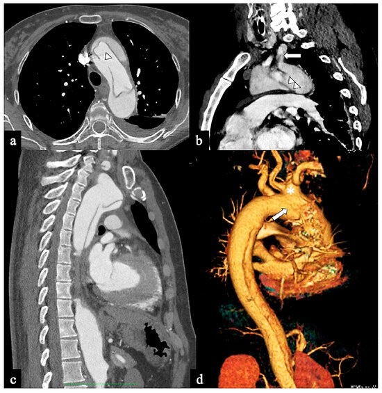 Non-A Non-B Acute Aortic Dissection: Is There Some Confusion in the ...