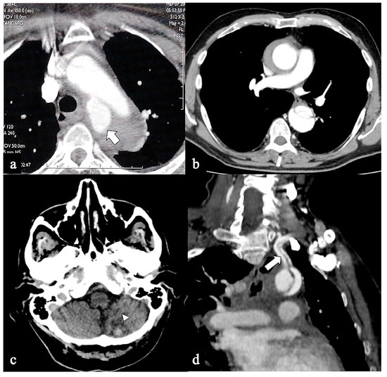 Non-A Non-B Acute Aortic Dissection: Is There Some Confusion in the ...